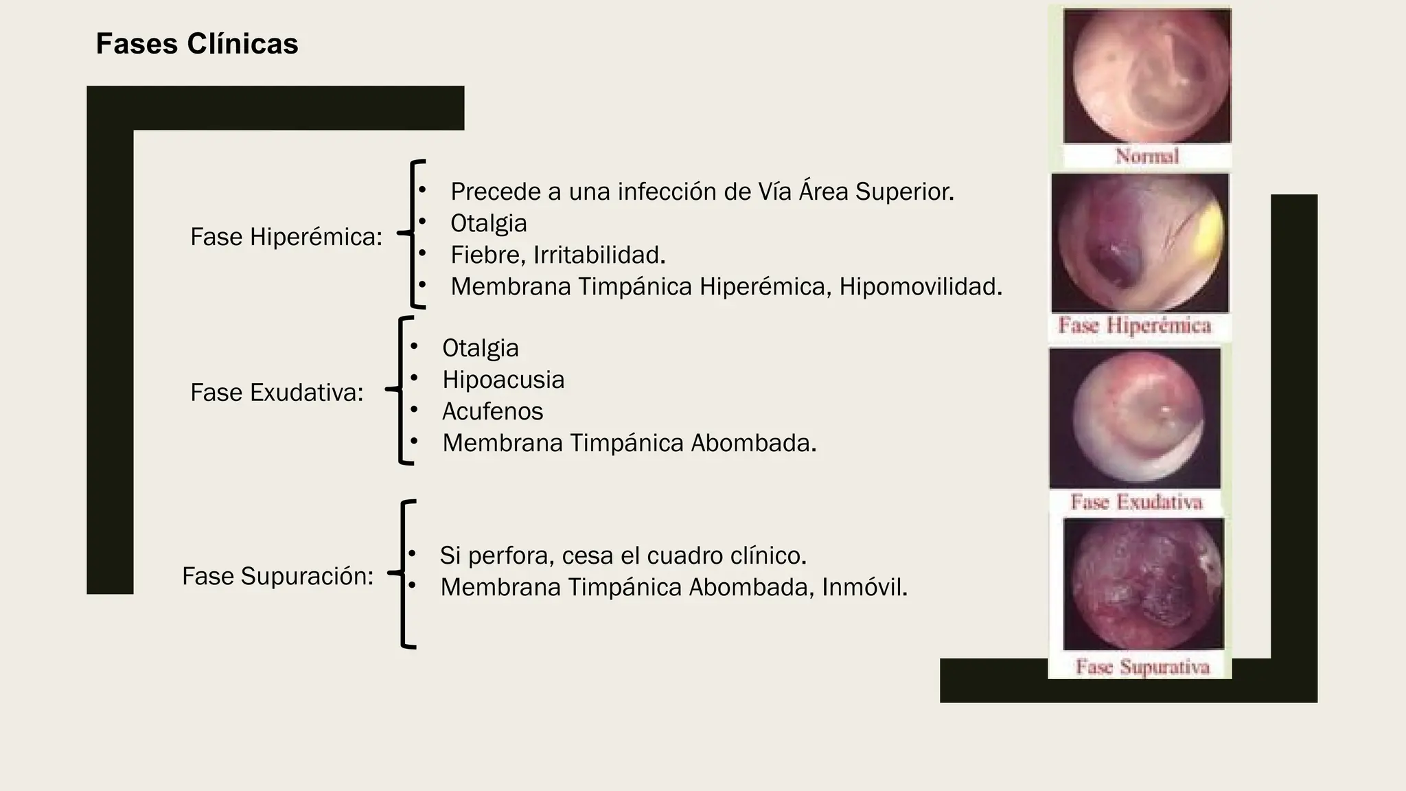Otitis Media Aguda, Mastoiditis y Complicaciones.pptx