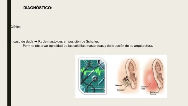 Otitis Media Aguda, Mastoiditis y Complicaciones.pptx