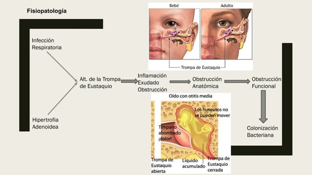 Otitis Media Aguda, Mastoiditis y Complicaciones.pptx