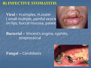 O-DISEASES OF BUCCAL CAVITY.ppt JFK JFK of | PPT