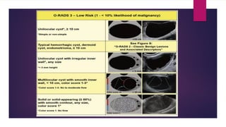 O-RADS Classification Of Ovarian Lesions | PPT