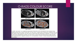 O-RADS Classification Of Ovarian Lesions | PPT