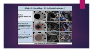 O-RADS Classification Of Ovarian Lesions | PPT