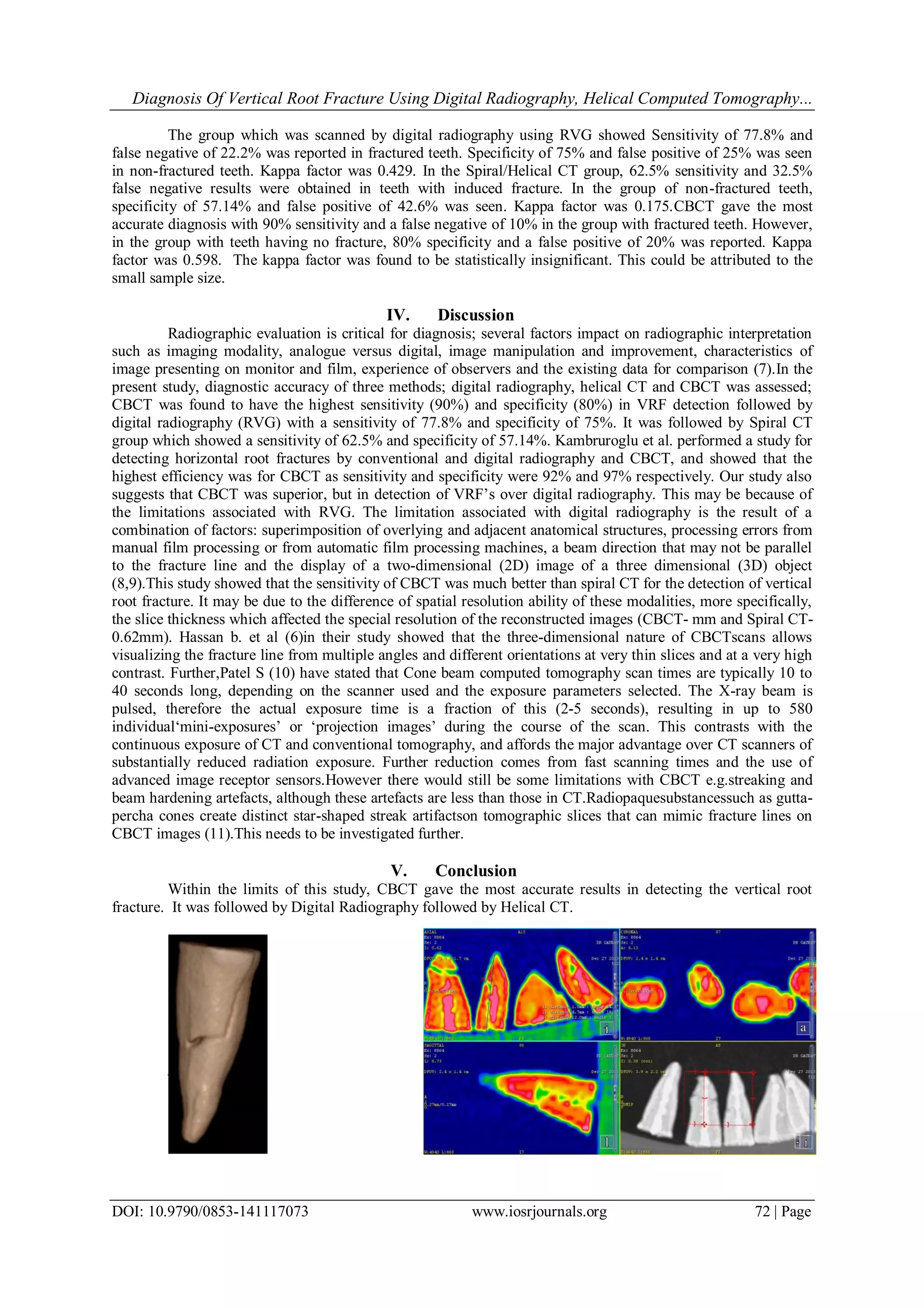 Diagnosis of Vertical Root Fracture Using Digital Radiography, Helical ...