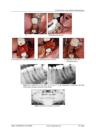 Corticotomy in the Modern Orthodontics | PDF