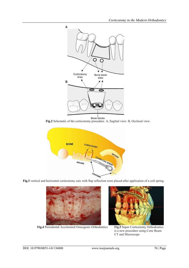 Corticotomy in the Modern Orthodontics | PDF