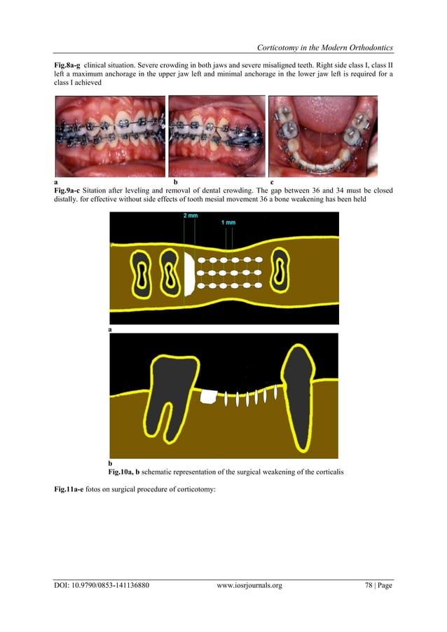 Corticotomy in the Modern Orthodontics | PDF
