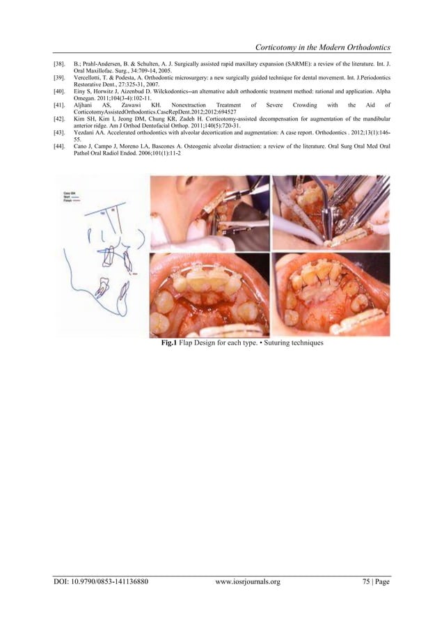 Corticotomy in the Modern Orthodontics | PDF