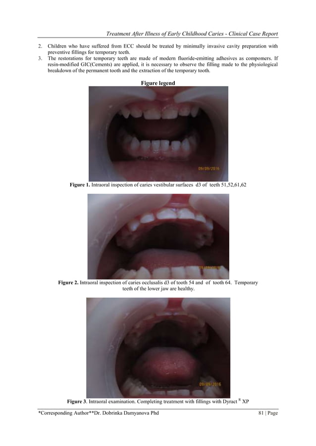 Treatment After Illness of Early Childhood Caries - Clinical Case ...