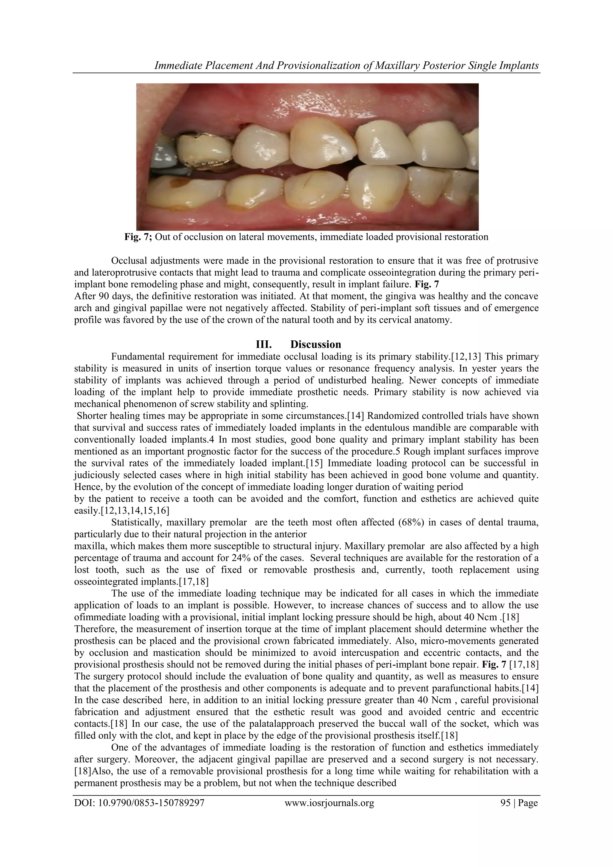 Immediate Placement and Provisionalization of Maxillary Posterior Single Implants | PDF | Dental ...