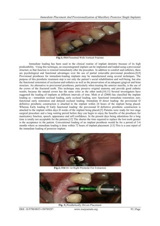 Immediate Placement and Provisionalization of Maxillary Posterior Single Implants | PDF | Dental ...