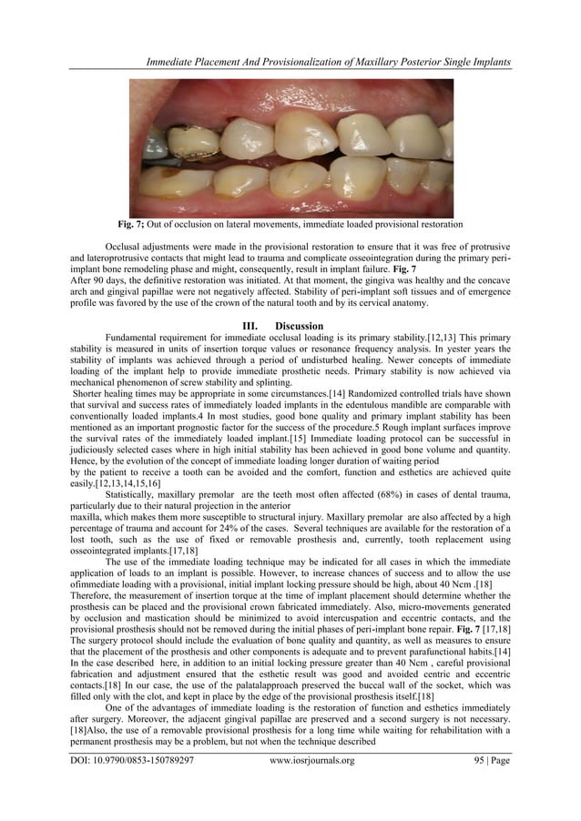 Immediate Placement and Provisionalization of Maxillary Posterior Single Implants | PDF | Dental ...