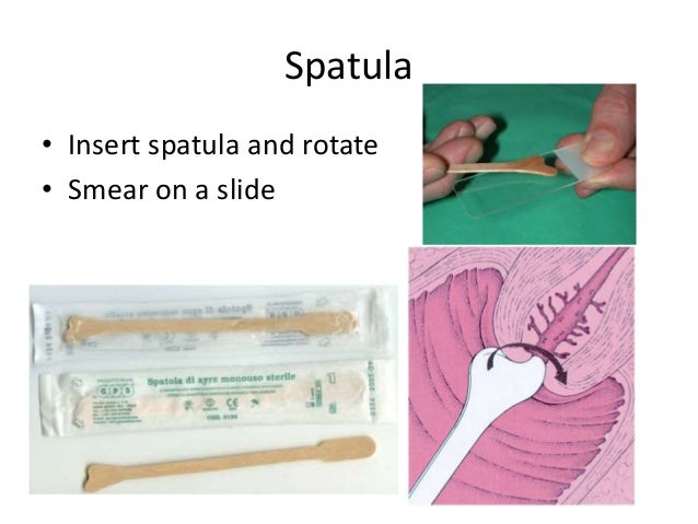 CIN and Cervical Screening