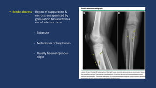 Infections in Orthopedics - how to mange | PPTX