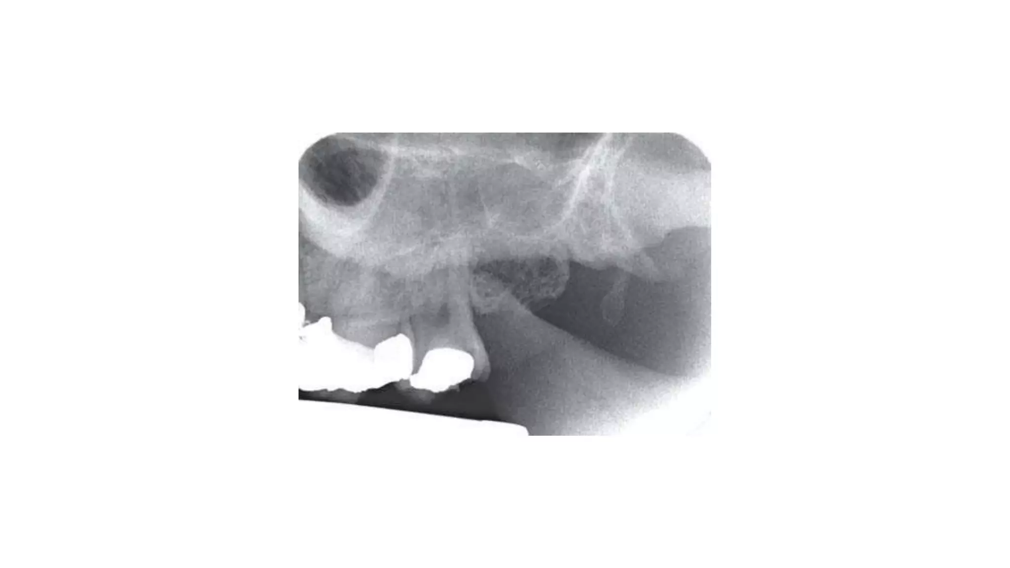 periapical radiopacities | PPTX