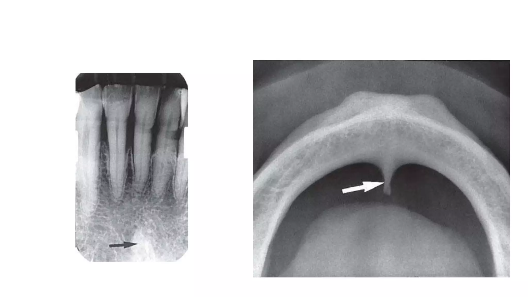 periapical radiopacities | PPTX
