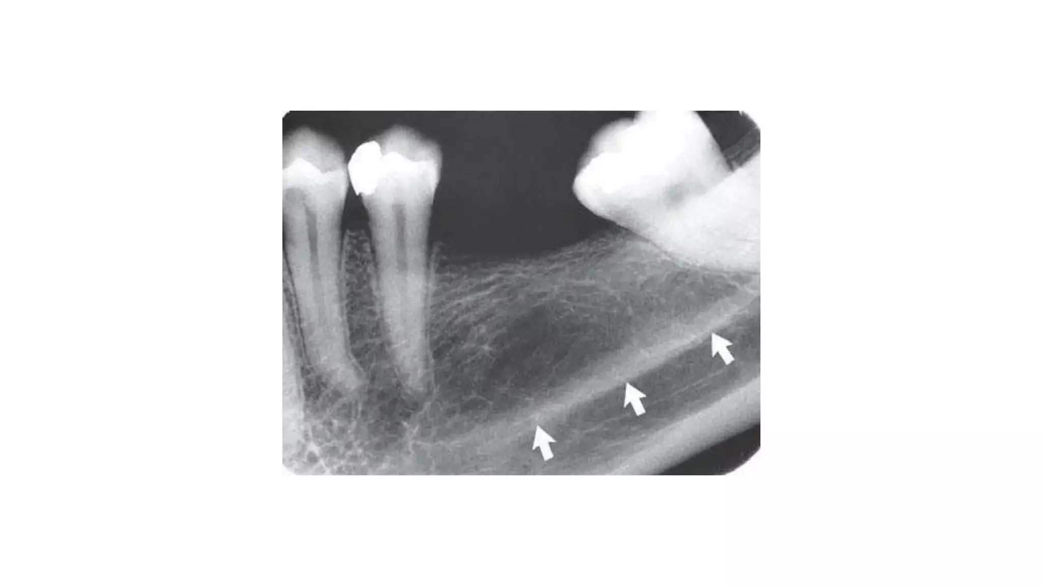 periapical radiopacities | PPTX