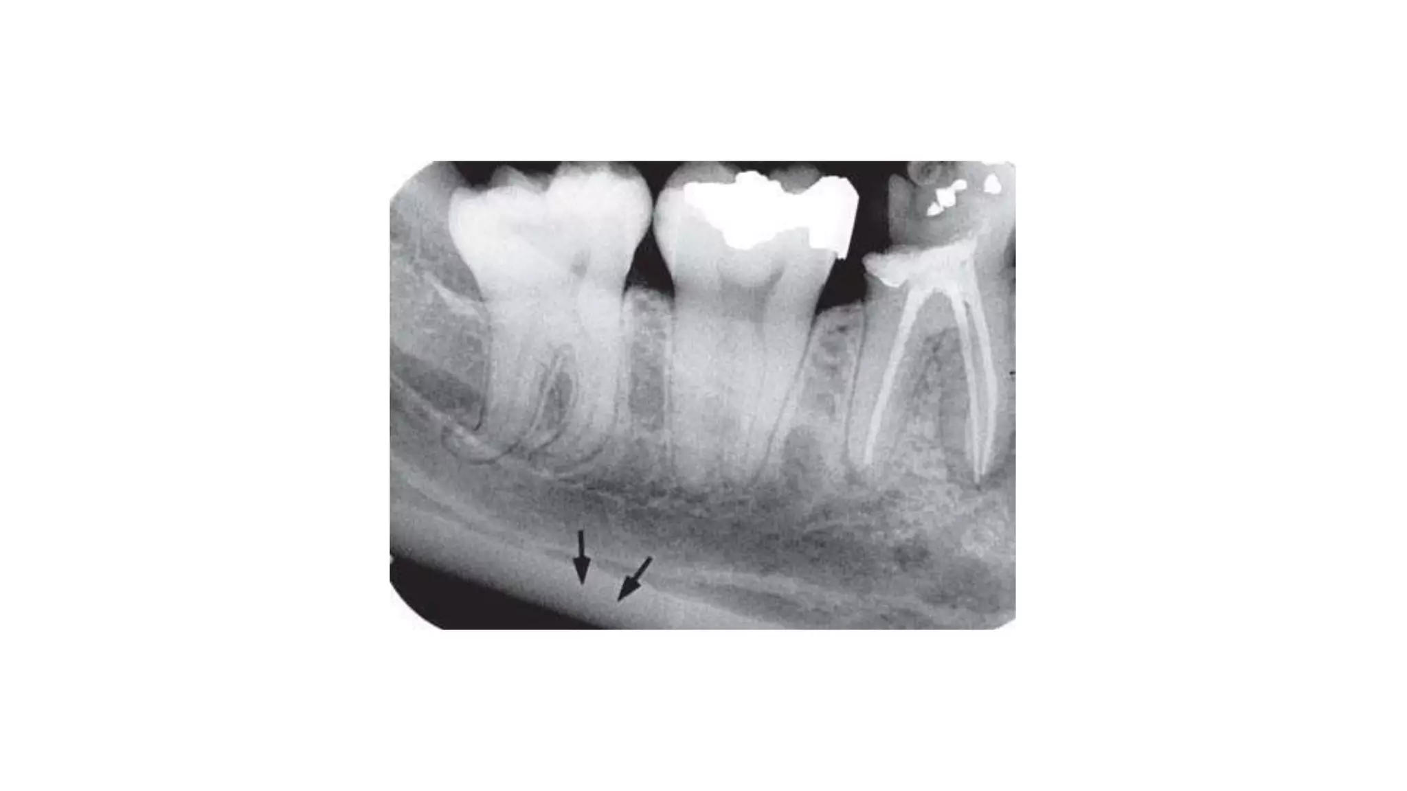 periapical radiopacities | PPTX