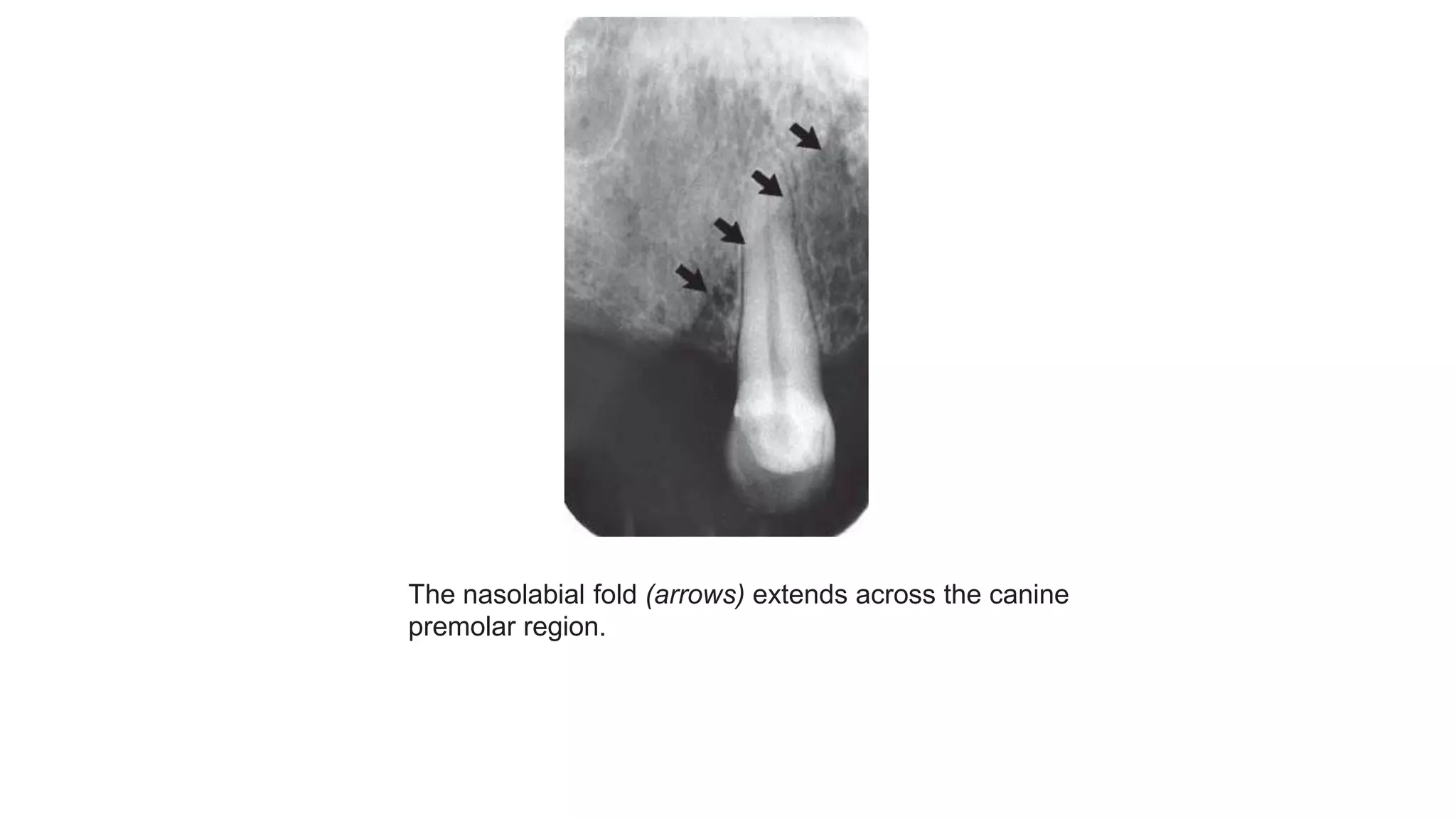 periapical radiopacities | PPTX