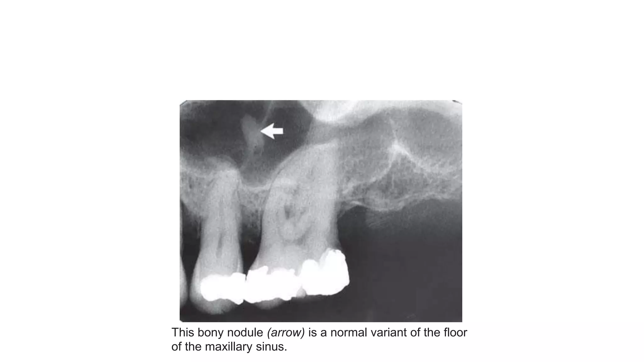 periapical radiopacities | PPTX
