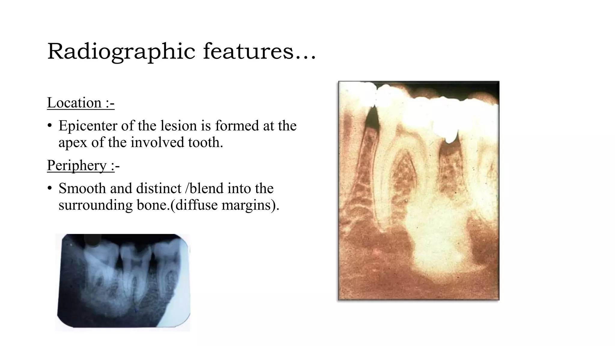 periapical radiopacities | PPTX