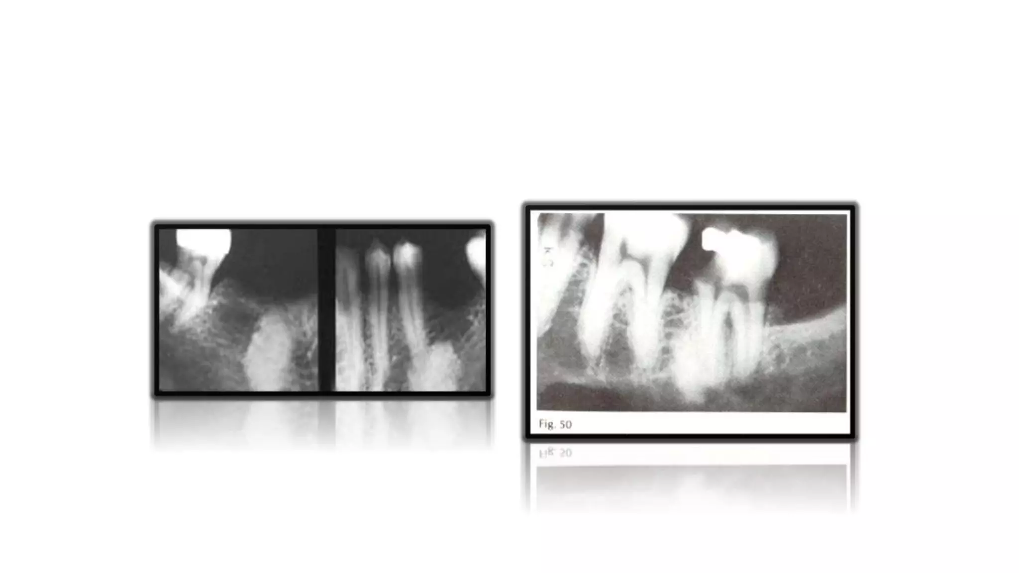periapical radiopacities | PPTX