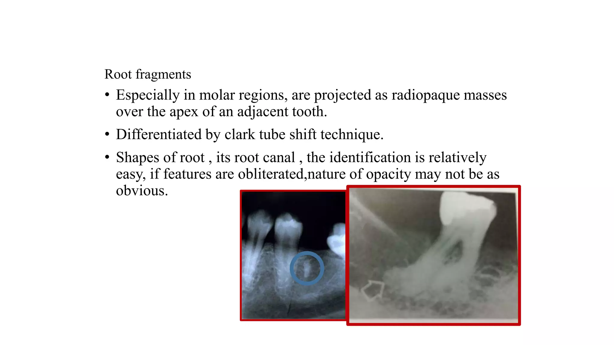 periapical radiopacities | PPTX