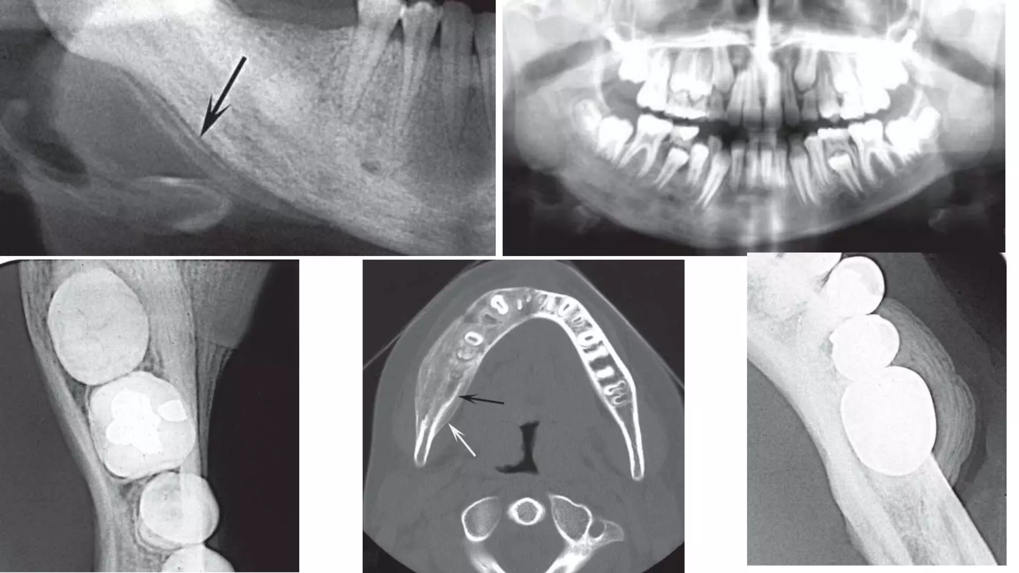 periapical radiopacities | PPTX