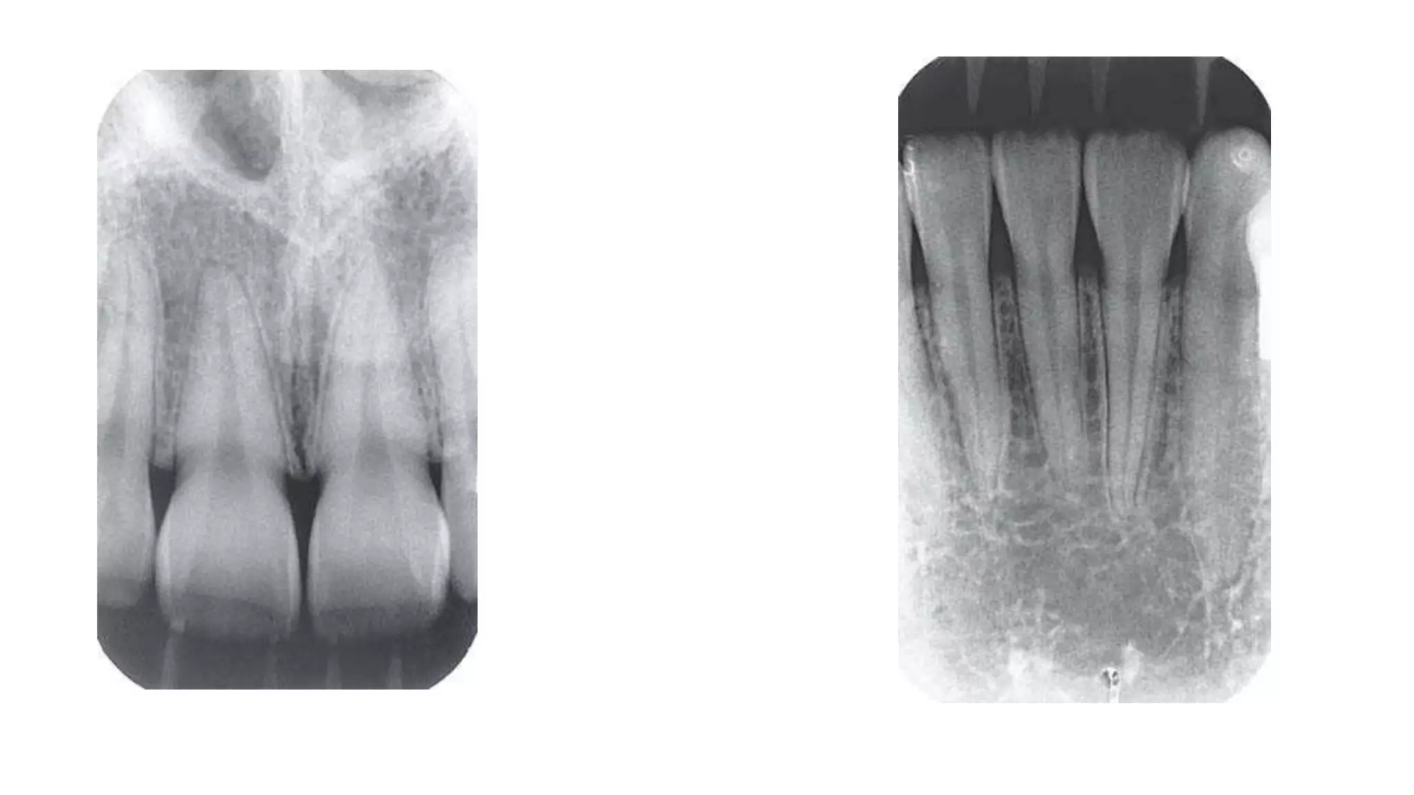 periapical radiopacities | PPTX