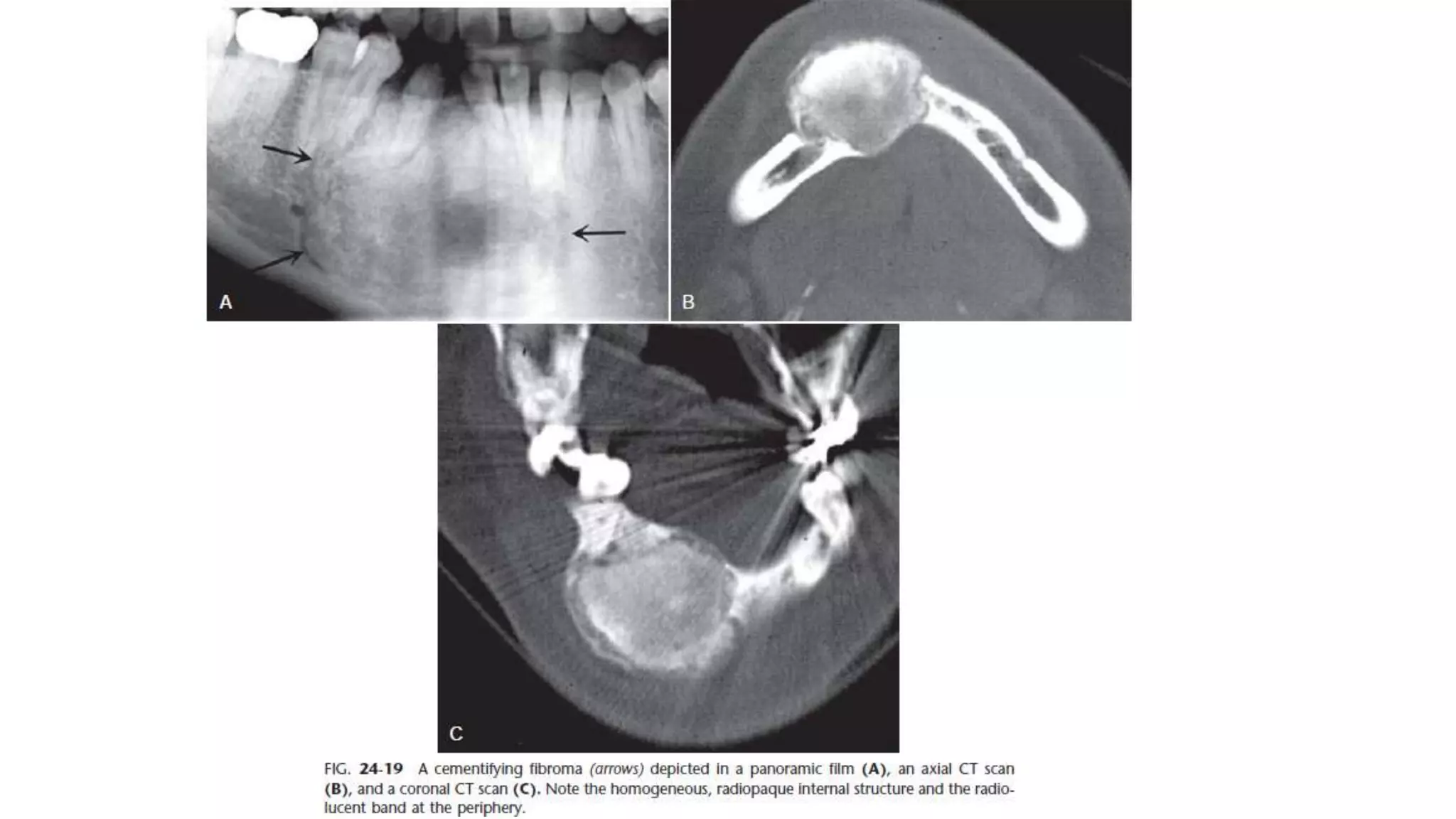 periapical radiopacities | PPTX