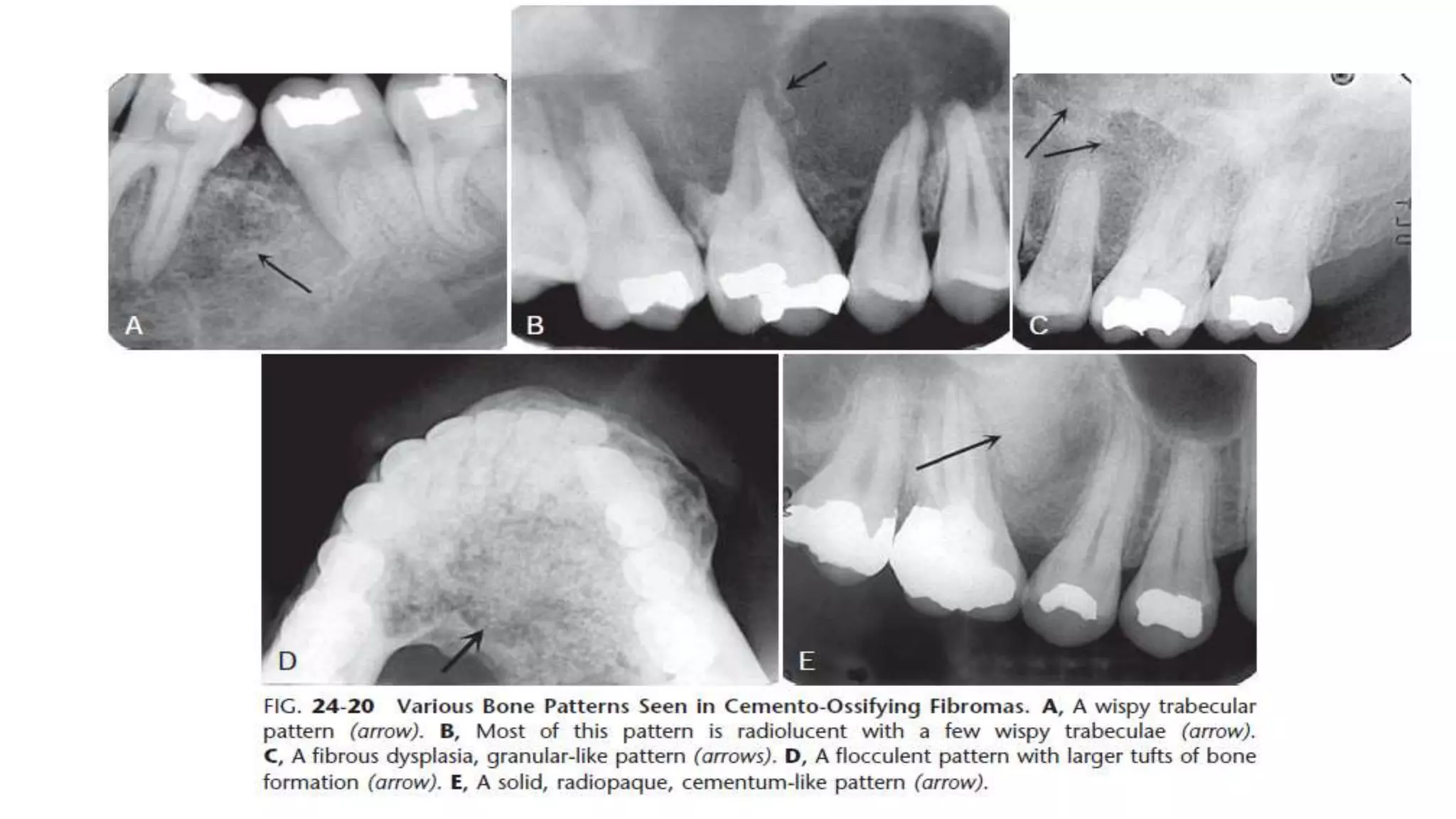 periapical radiopacities | PPTX