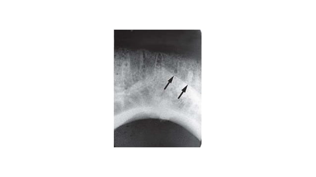 periapical radiopacities | PPTX | Bone and Joint Conditions | Diseases ...