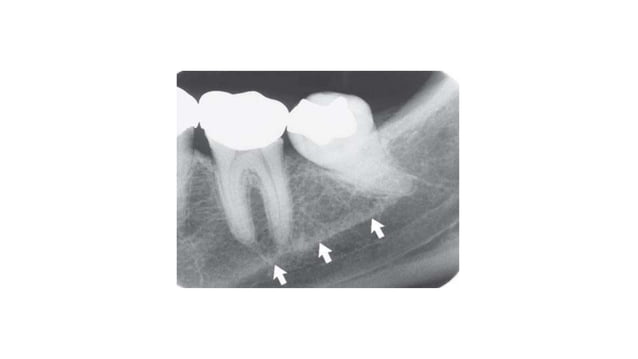 periapical radiopacities | PPTX | Bone and Joint Conditions | Diseases ...