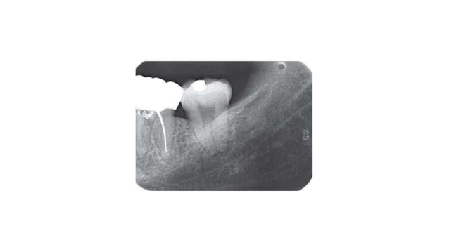 periapical radiopacities | PPTX | Bone and Joint Conditions | Diseases ...