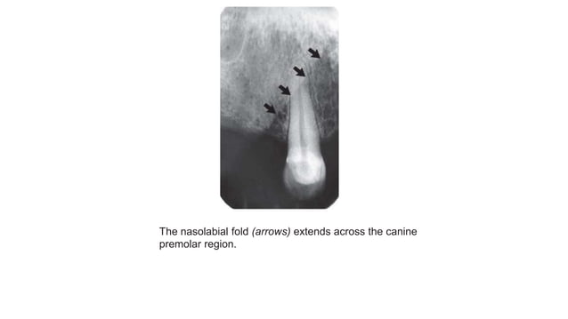 periapical radiopacities | PPTX | Bone and Joint Conditions | Diseases ...