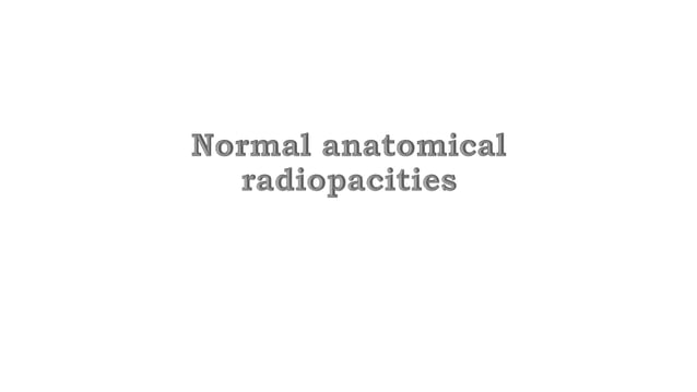 periapical radiopacities | PPTX | Bone and Joint Conditions | Diseases ...