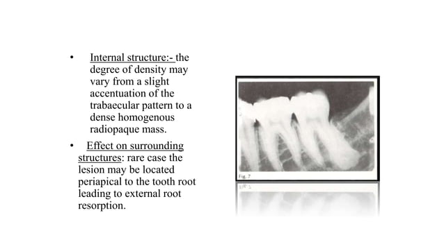 periapical radiopacities | PPTX | Bone and Joint Conditions | Diseases ...
