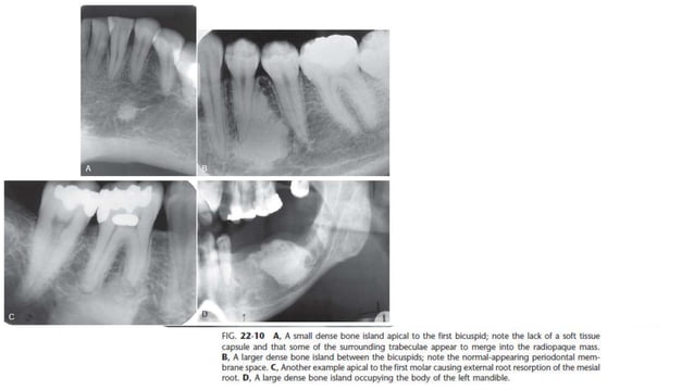 periapical radiopacities | PPTX | Bone and Joint Conditions | Diseases ...