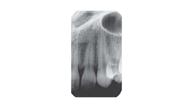 periapical radiopacities | PPTX | Bone and Joint Conditions | Diseases ...