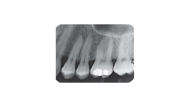 periapical radiopacities | PPTX | Bone and Joint Conditions | Diseases ...