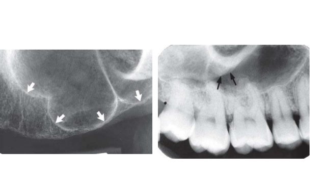 Idiopathic Osteosclerosis Vs Condensing Osteitis