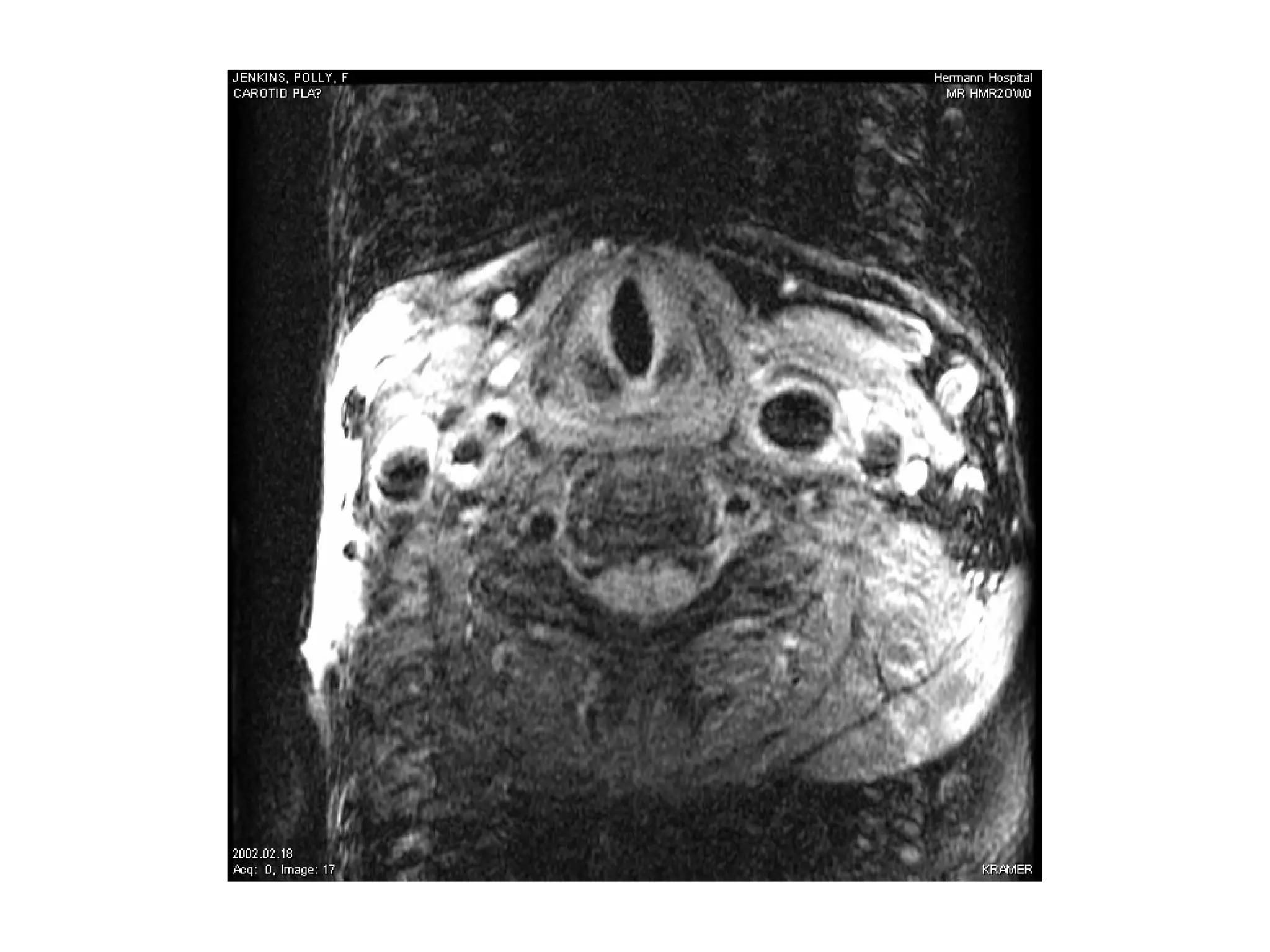 Carotid mri images | PPT