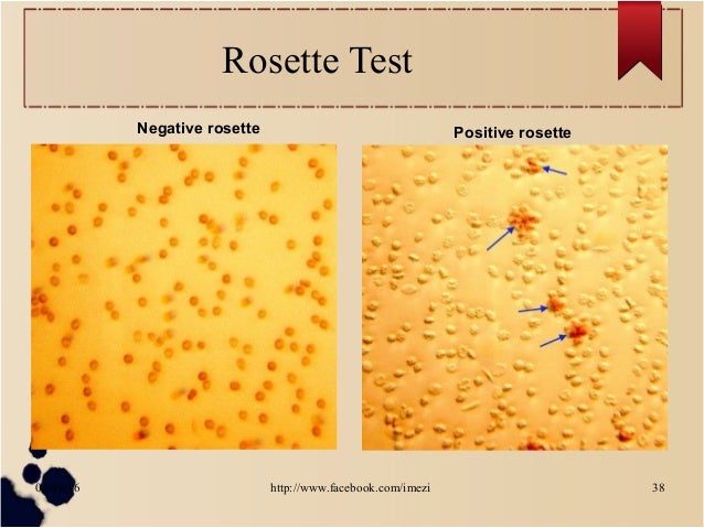 Management of Rh negative pregnancy
