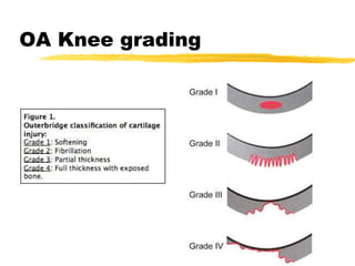 Osteoarthritis lecture for UG | PPTX
