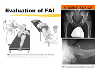 Osteoarthritis lecture for UG | PPTX