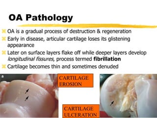 Osteoarthritis lecture for UG | PPTX