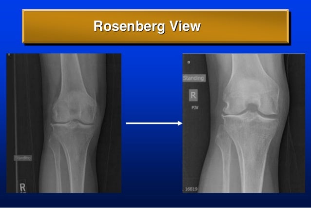 2016: Osteoarthritis and Total Joint Replacement-Meyer