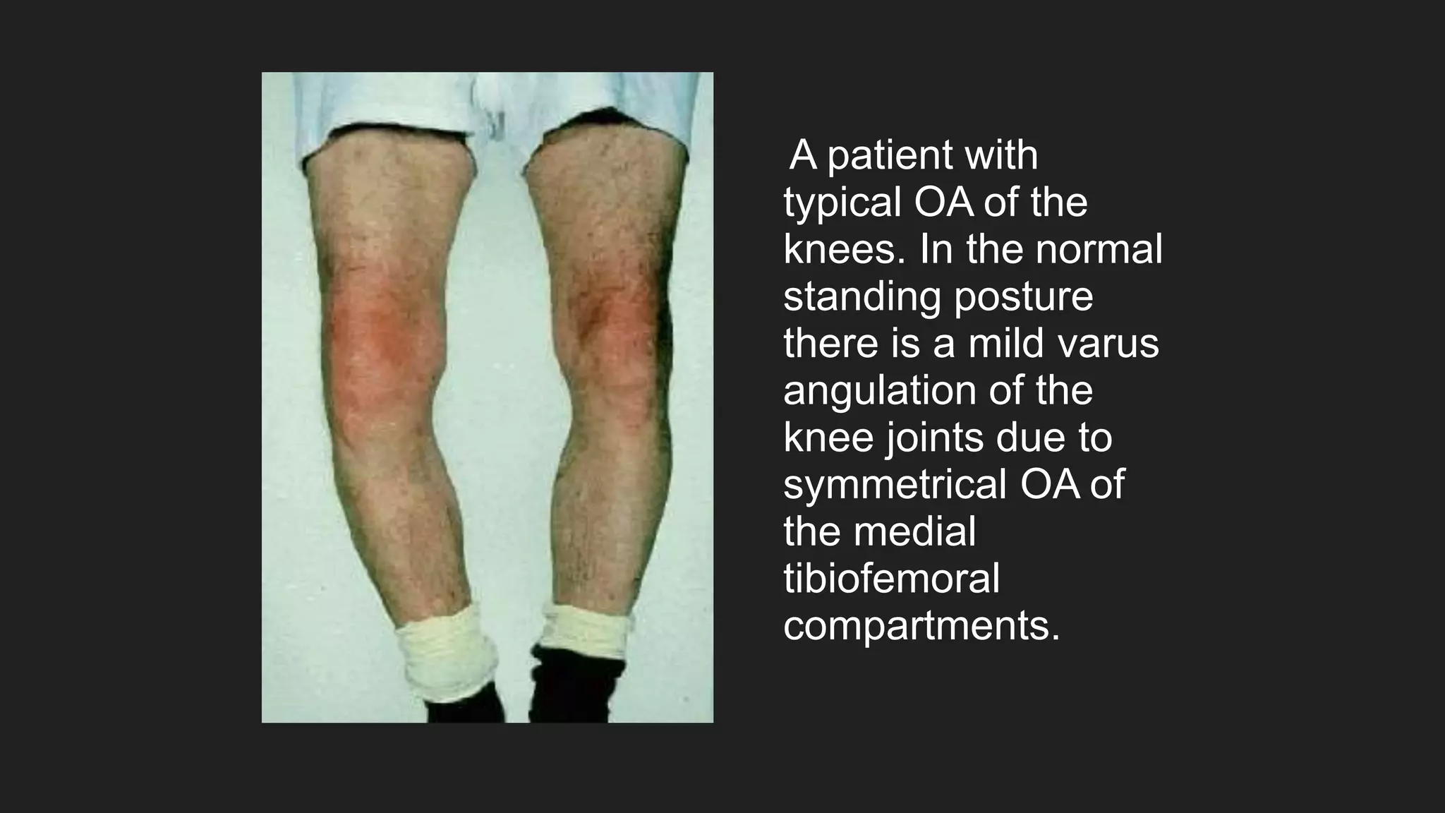Osteoarthritis | PPTX