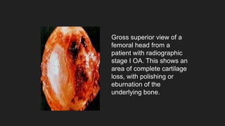 Osteoarthritis | PPTX