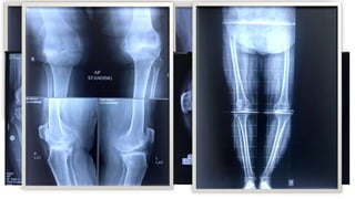 practical tips in planning TKR | PPTX